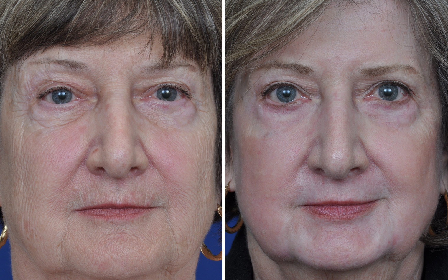 Laser Skin Resurfacing Before And After Annapolis Plastic Surgery